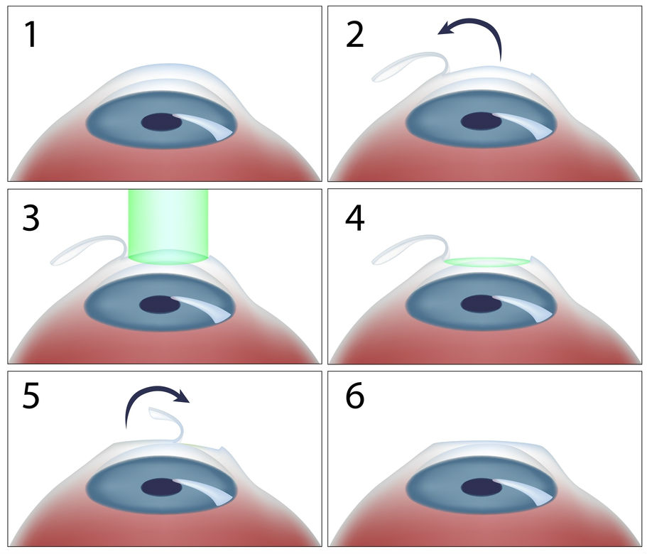 Eye Surgery in Redding Red Bluff Chico, CA